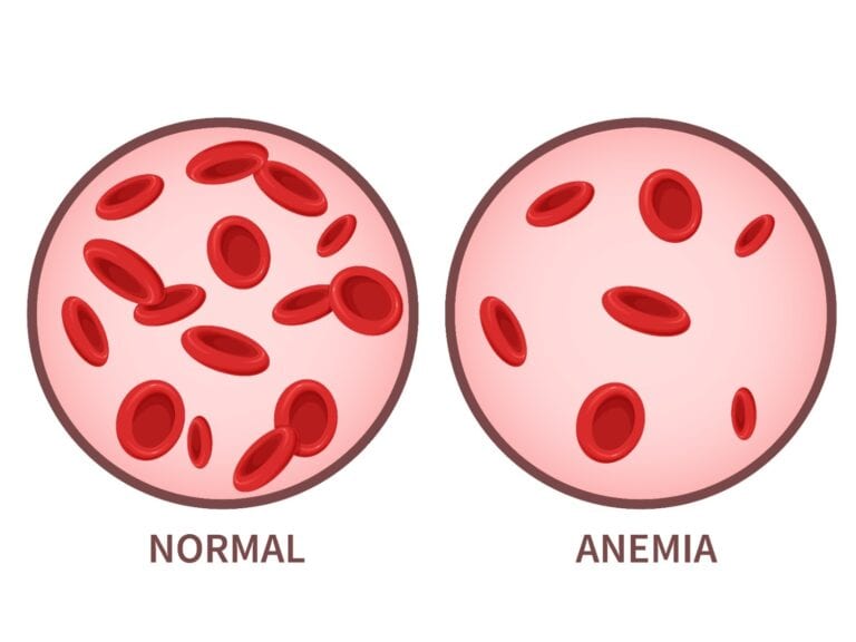 What are the main signs of anemia? - Family Hospital